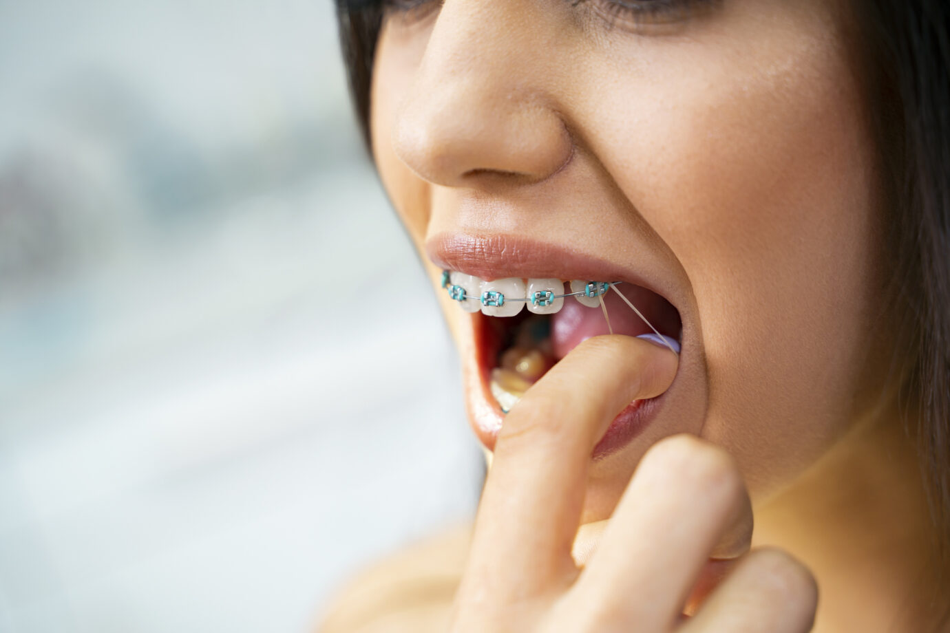 Slotjesbeugel (blokjesbeugel) nodig? Lees snel meer - TopOrtho