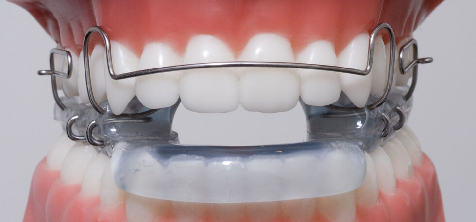 Blokbeugel bij een overbeet - TopOrtho